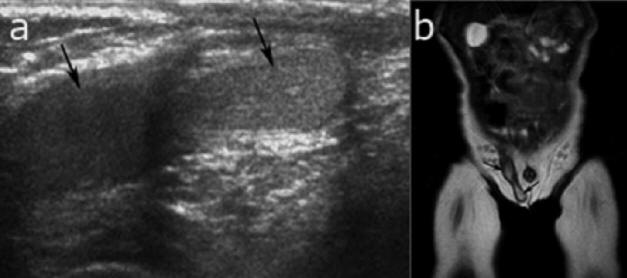 A Case Presentation With Tranverse Testicular Ectopia | Cece ...